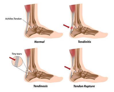 Achilles Tendonitis - Adelaide Heel Pain Clinics