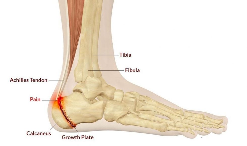 Sever’s Disease Treatment Rose Park | Children's Heel Pain